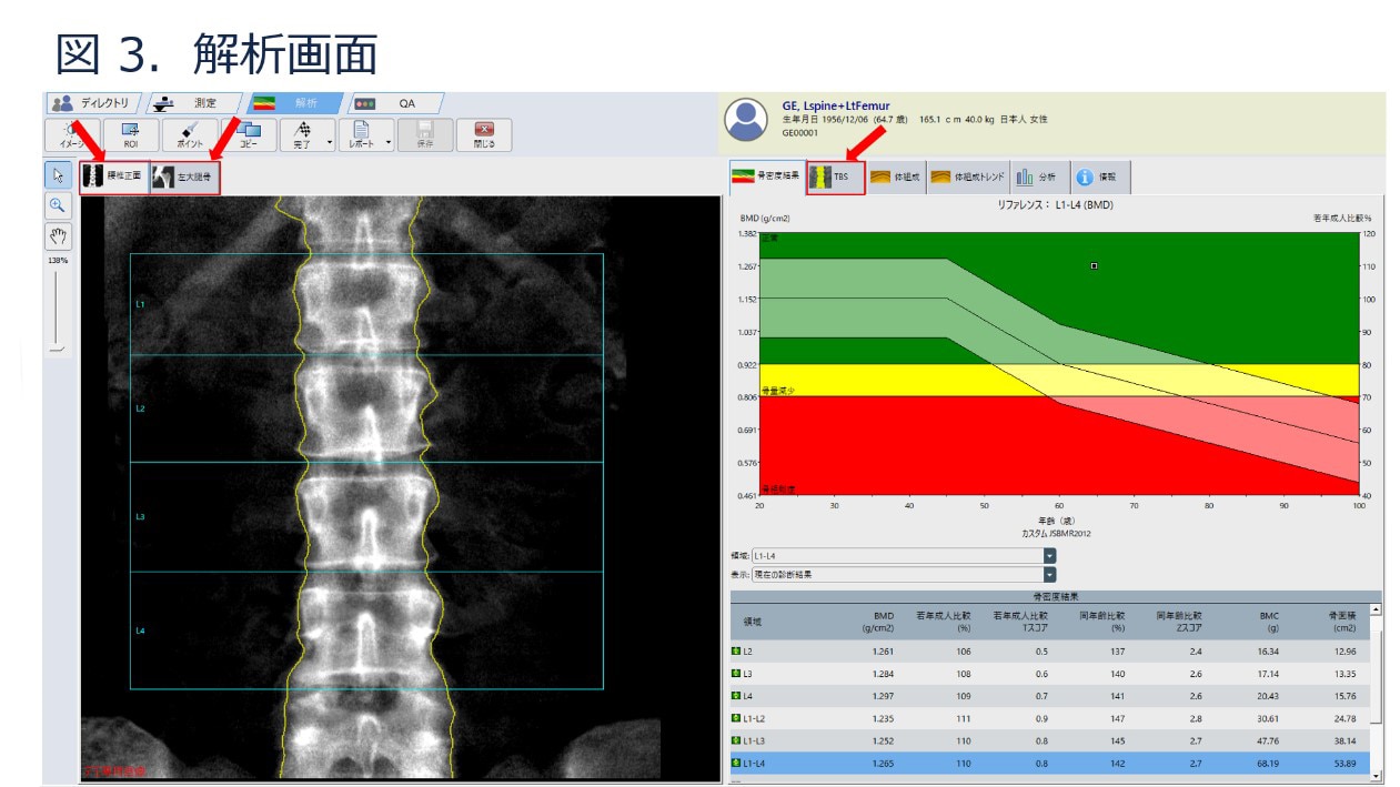 GE DXA装置の検査効率（スループット）について｜骨密のコツ | GE Healthcare (Japan)