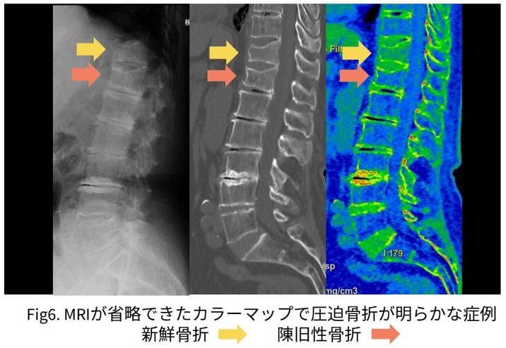 最北端のDual Energy64列CT装置 胸腰椎圧迫骨折におけるDual 最北端のDual Energy64列CT装置 胸腰椎圧迫骨折におけるDual