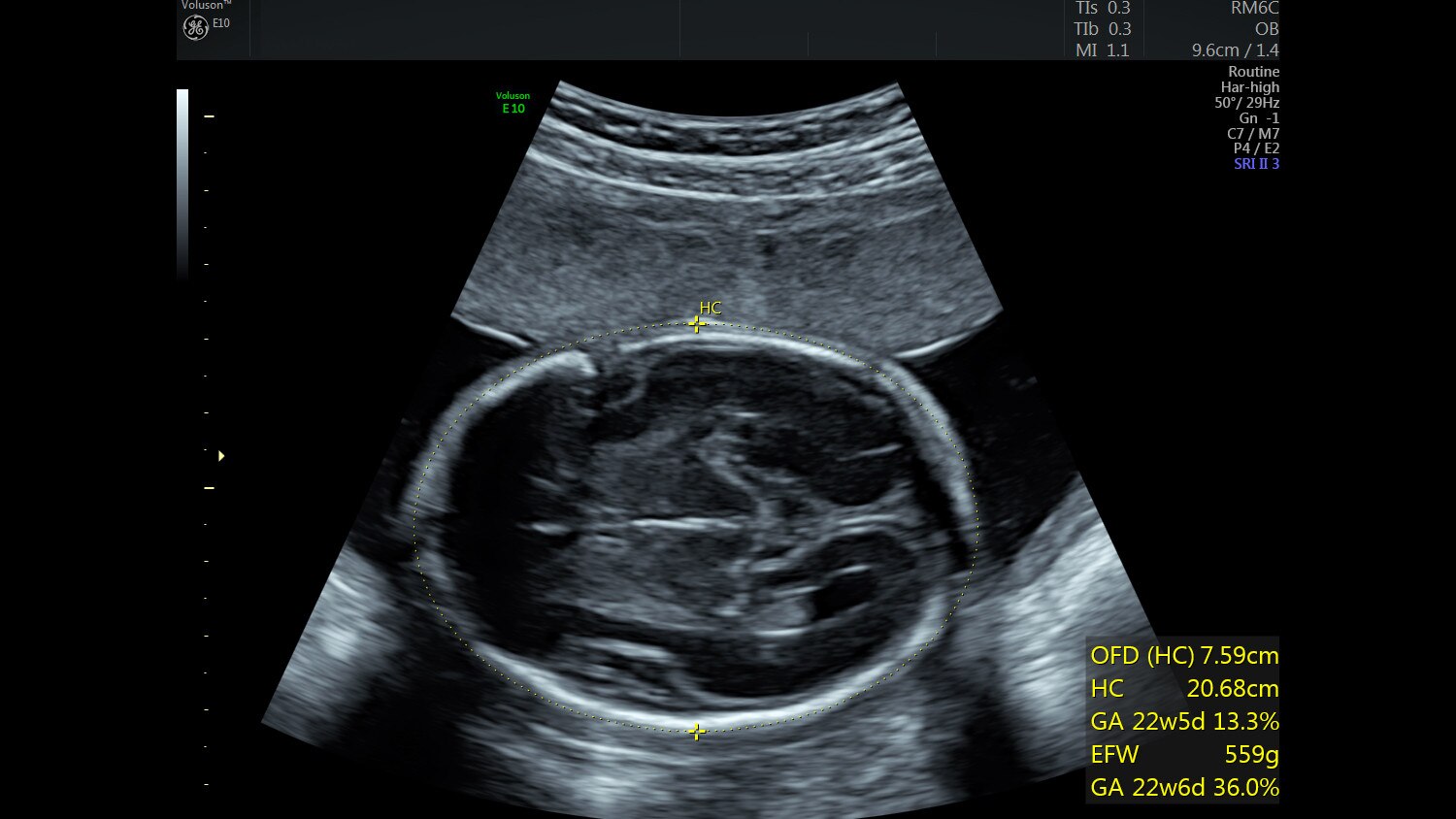 妊娠初期胎児 - Voluson E10 - Voluson - 超音波 - 製品 | GE Healthcare (Japan)