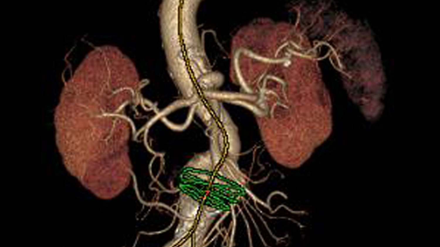 Interventional Advanced Visualization | GE HealthCare (Japan)